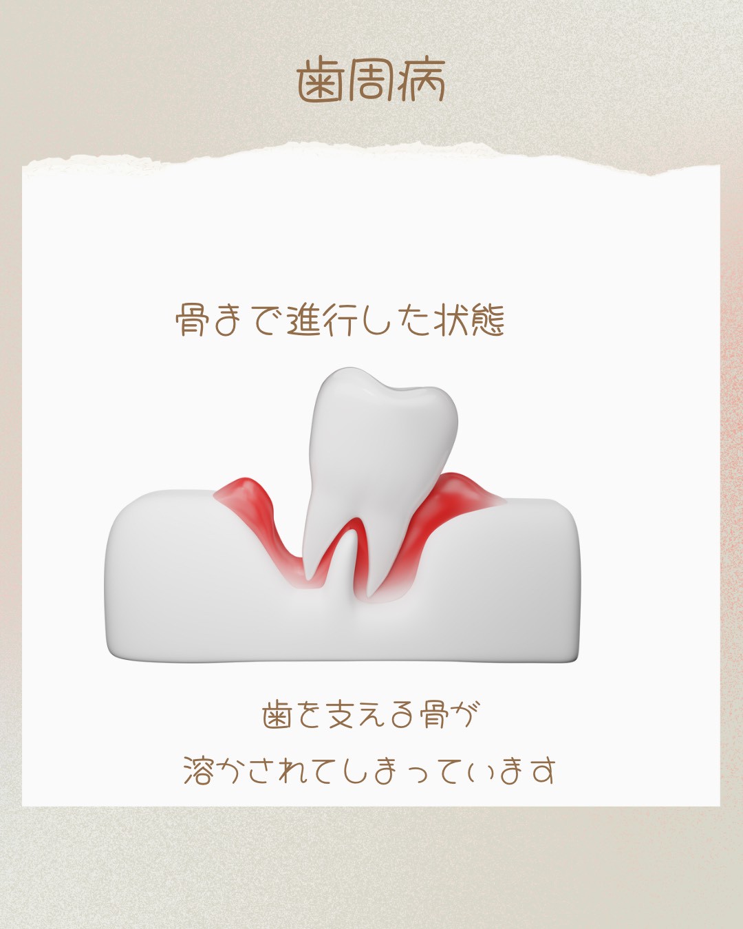 虫歯や歯周病は「早期発見」がとても大切です | 恵比寿・伊勢原の歯医者・歯科・インプラント・矯正・審美歯科・美容外科・美容皮膚科｜ピュアグループ